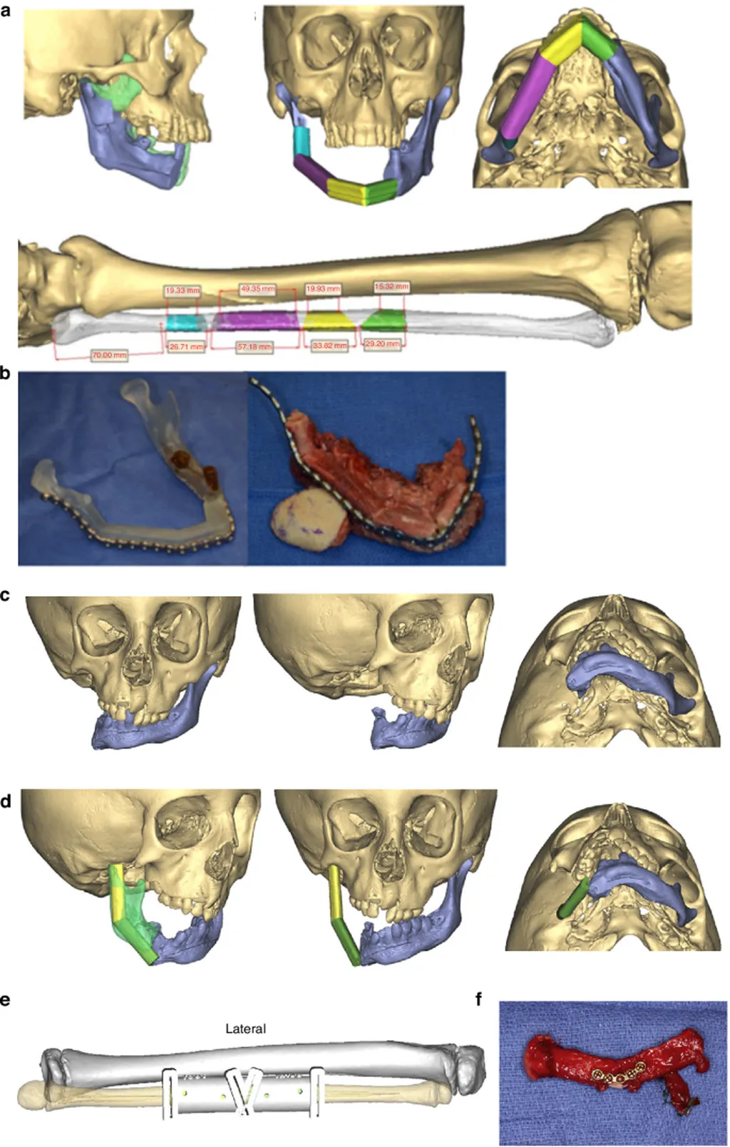 Egyptian Breakthrough: Computer-Assisted Surgery Revolutionizes TMJ ...